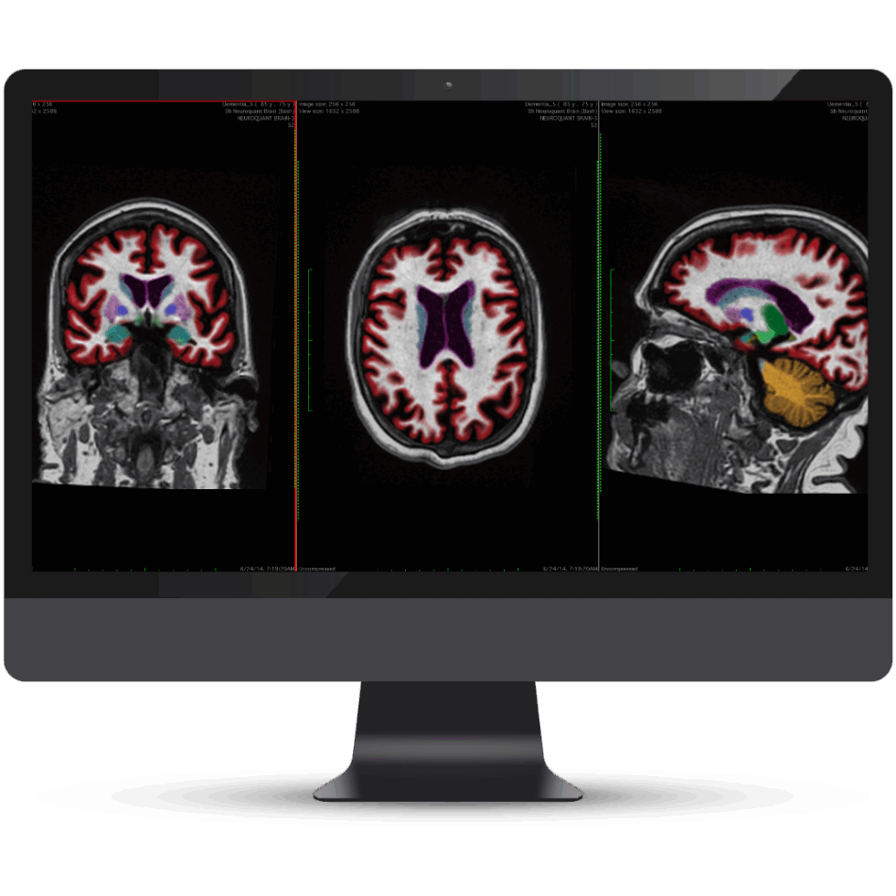 NeuroQuant Brain MRI Scans | ProScan Imaging