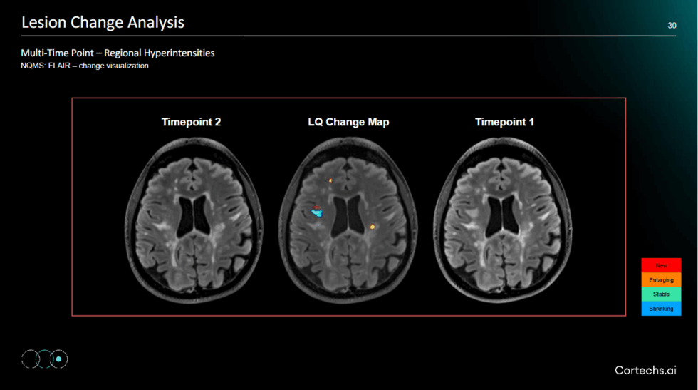 NeuroQuant Brain MRI Scans | ProScan Imaging